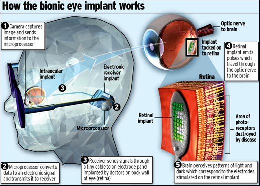 Woman gains sight with new bionic eye | Pakistan Defence